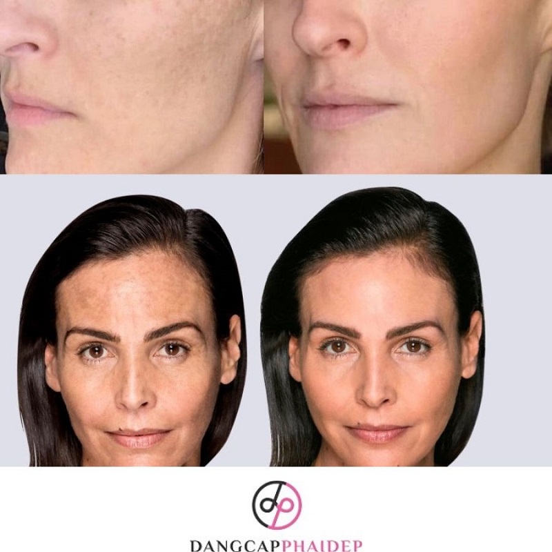 Mặt nạ điều trị sắc tố da dưỡng trắng Mesoestetic Dermamelan Ion Mask