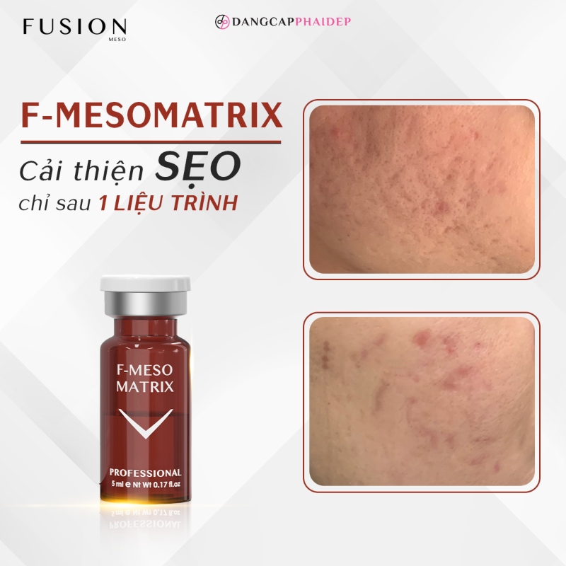 Fusion F-Meso Matrix hỗ trợ điều trị sẹo rỗ