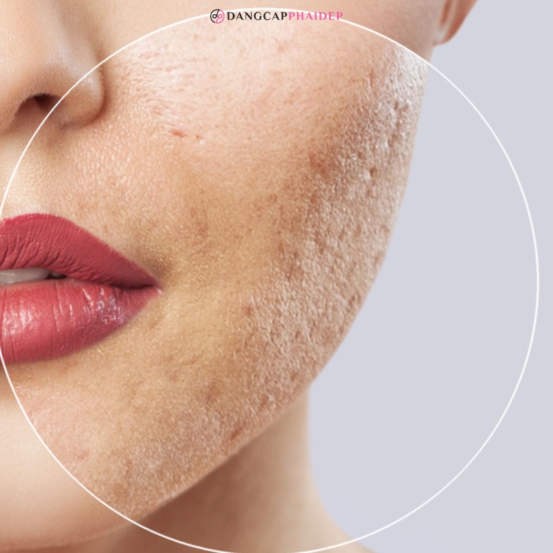 Fusion F-Meso Matrix hỗ trợ điều trị sẹo rỗ